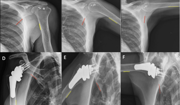Emory Healthcare Researchers Use Dynamic Digital Radiography to Compare ...
