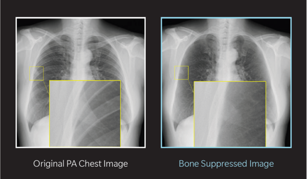 Bone Suppression Imaging | Konica Minolta Healthcare Americas, Inc.